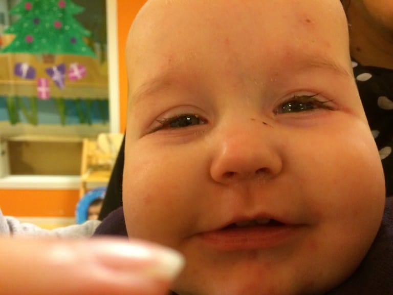 Aarswormen: tips voor jeuk, behandeling en voorkoming van wormpjes bij ...