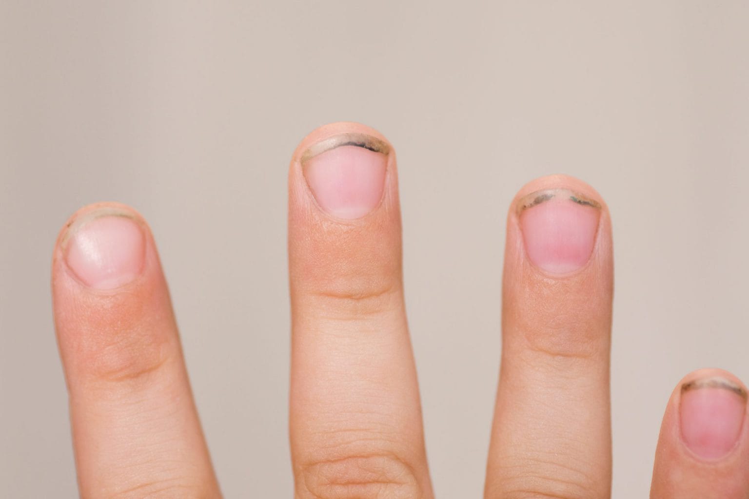 Vieze nagels; wees alert op krentenbaard en aarswormen - Meervanmir.eu